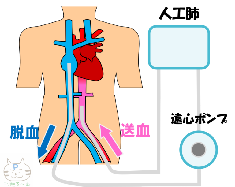 ECMO，PCPSって何？【原理からわかりやすく解説】 | 循環器Drぷーのコソ勉る〜む